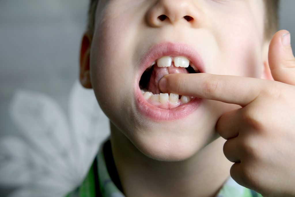 ¿Cuándo se realiza una operación del frenillo lingual en niños?